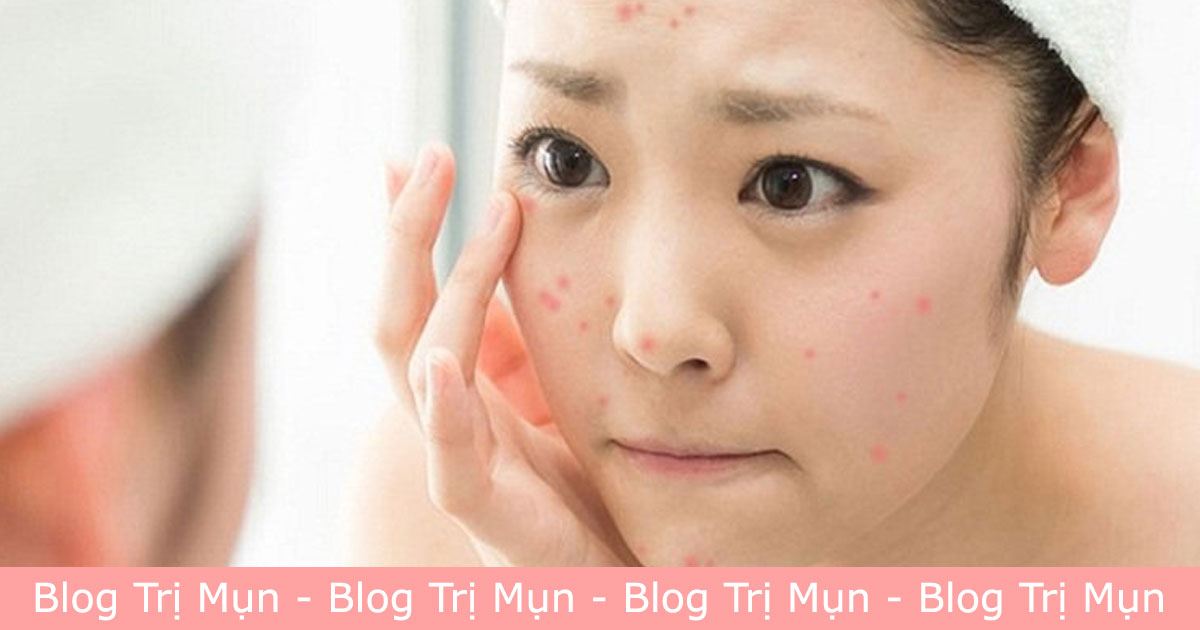 Tổng Hợp Thông Tin Trị Mụn - Giảm Mụn Mới Nhất - HappySkin Việt Nam